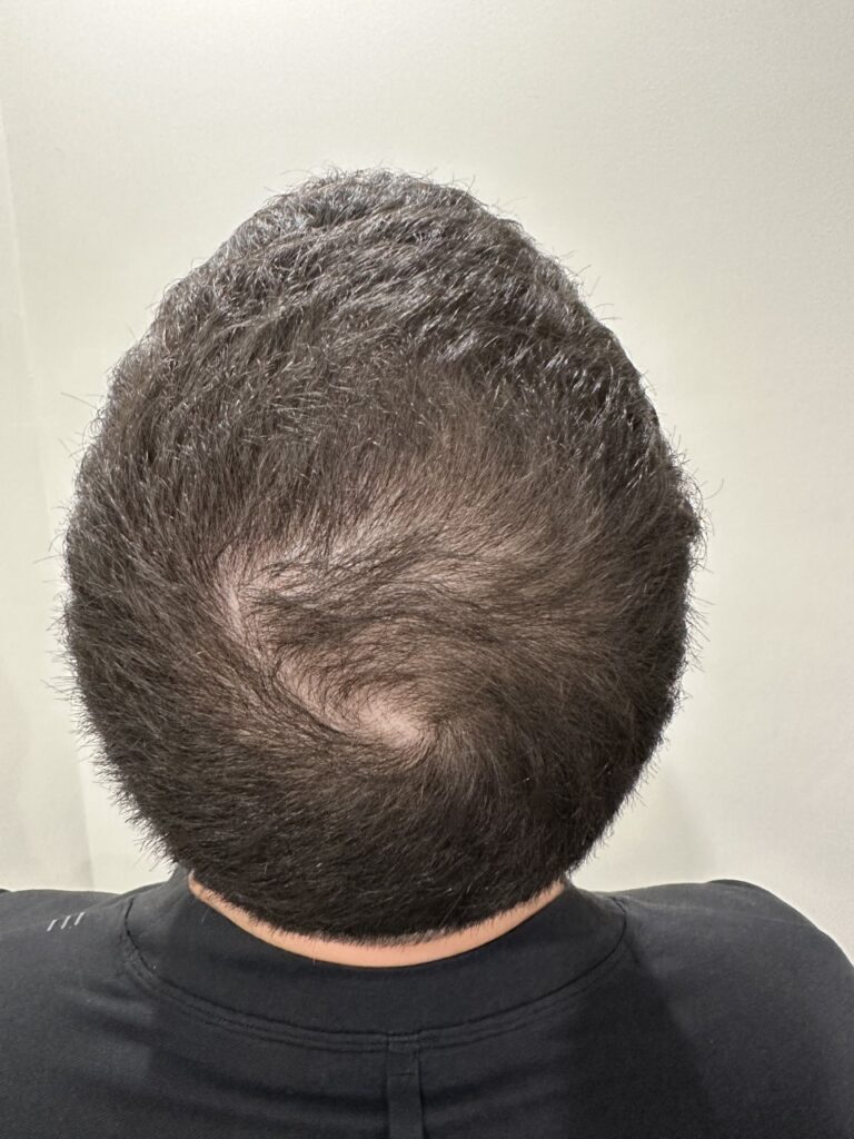 SMP Procedures 4 - Foundation Aesthetic Hair Restoration