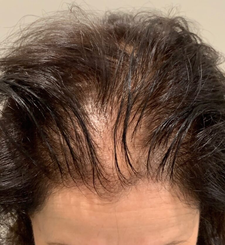 SMP Procedure 8 - Foundation Aesthetic Hair Restoration