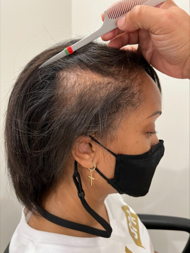 SMP Procedure 9 - Foundation Aesthetic Hair Restoration